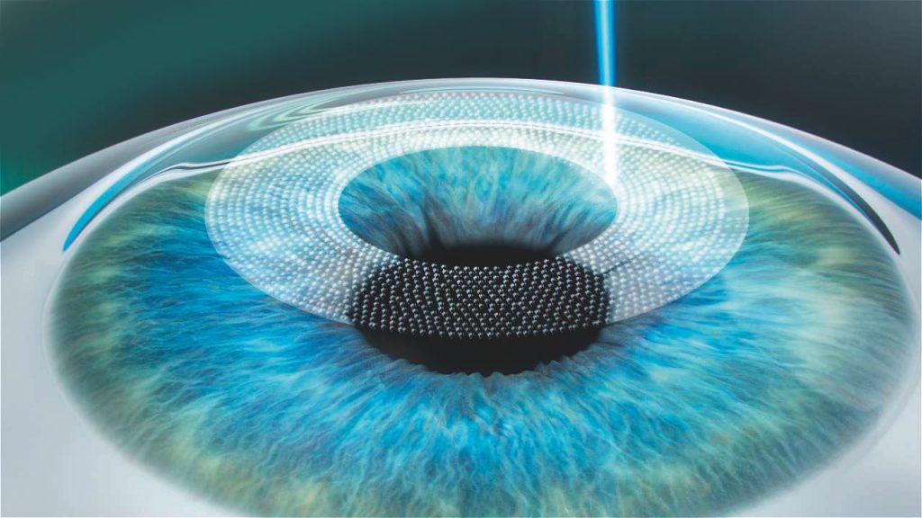 Femto-LASIK – accuratis